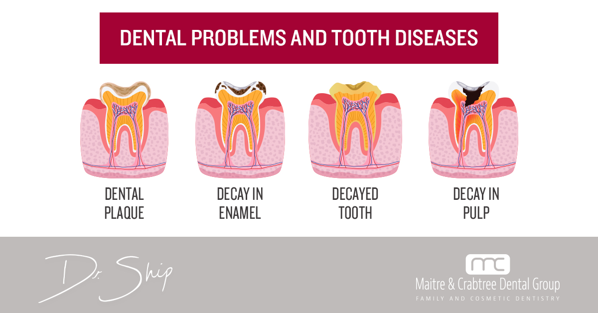 Learn the Warning Signs of Cavities - Ship Maitre, DMD
